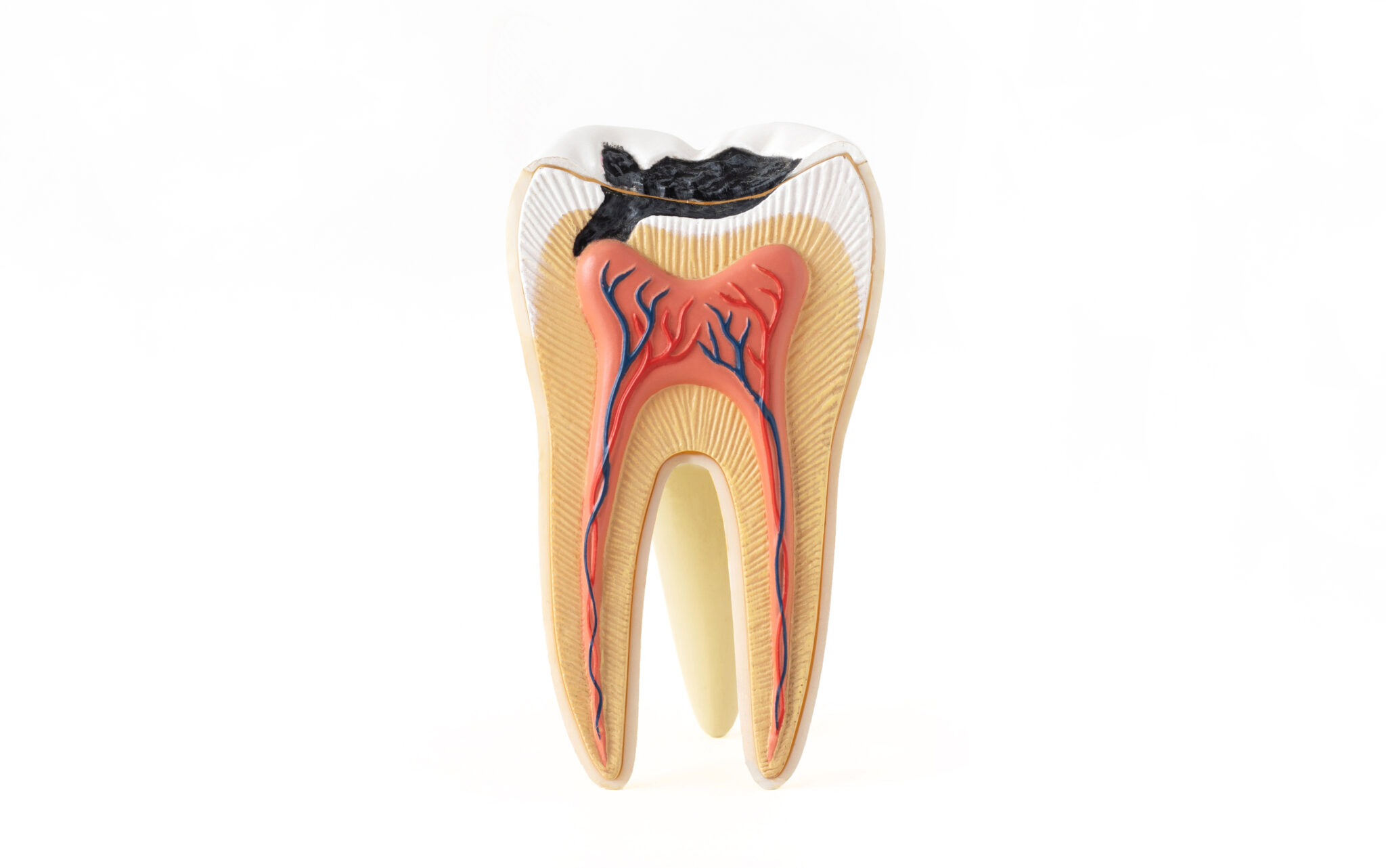 How to Care for Your Tooth After Root Canal Therapy